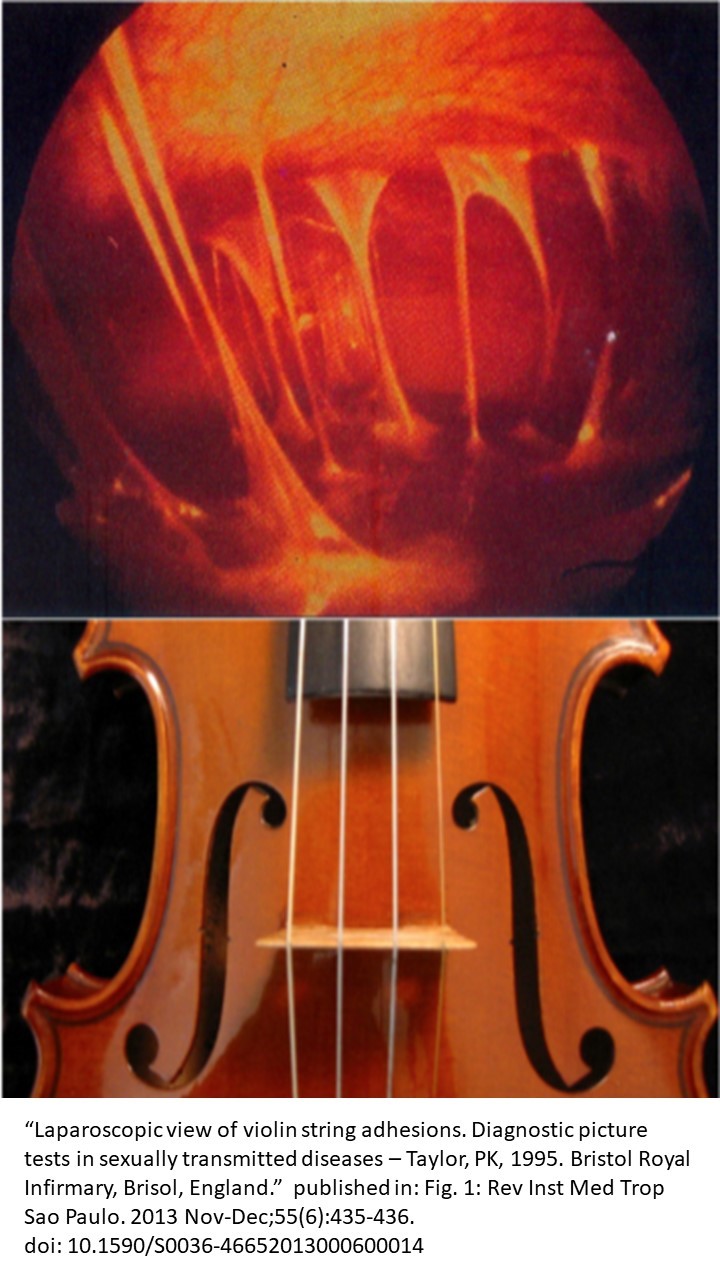 Fitz Hughes-Curtis Syndrome (FHCS) vs Endometriosis – Extrapelvic Not Rare